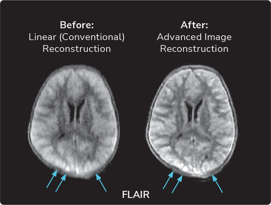 Advanced Image Reconstruction: Swoop® Portable MRI™