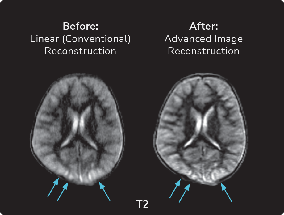 Advanced Image Reconstruction: Swoop® Portable MRI™