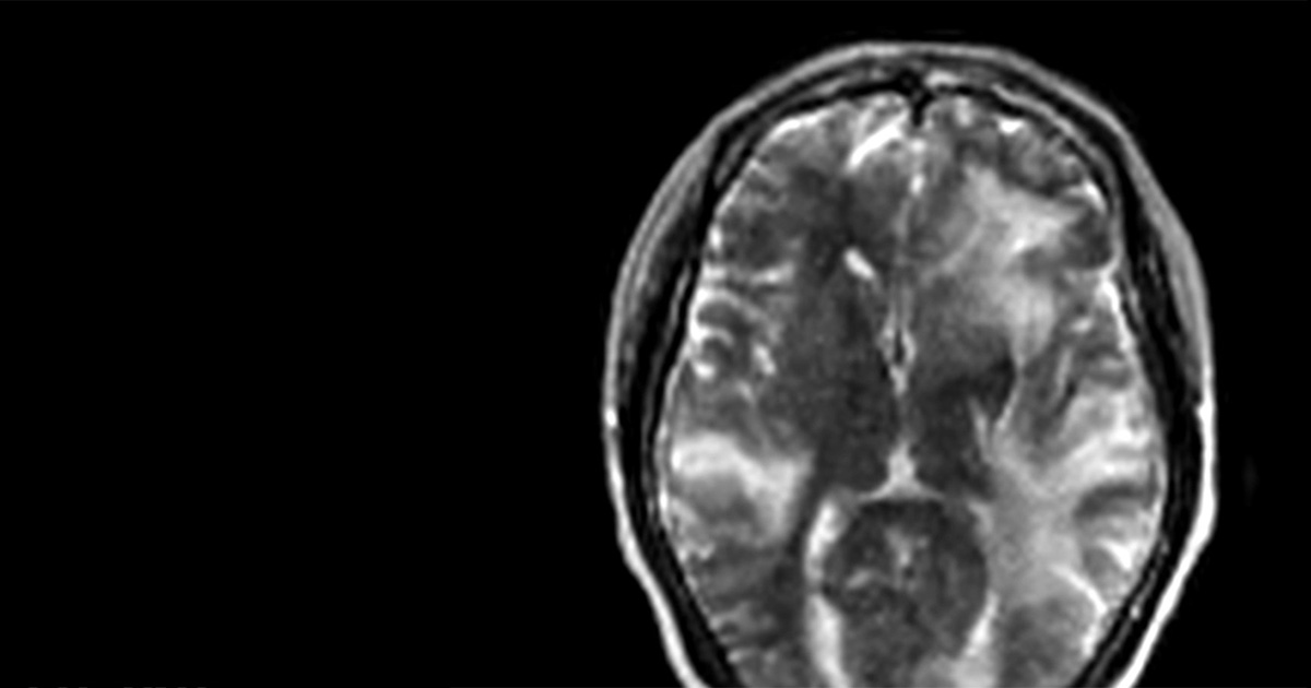 Understanding an MRI Brain Exam Without Contrast